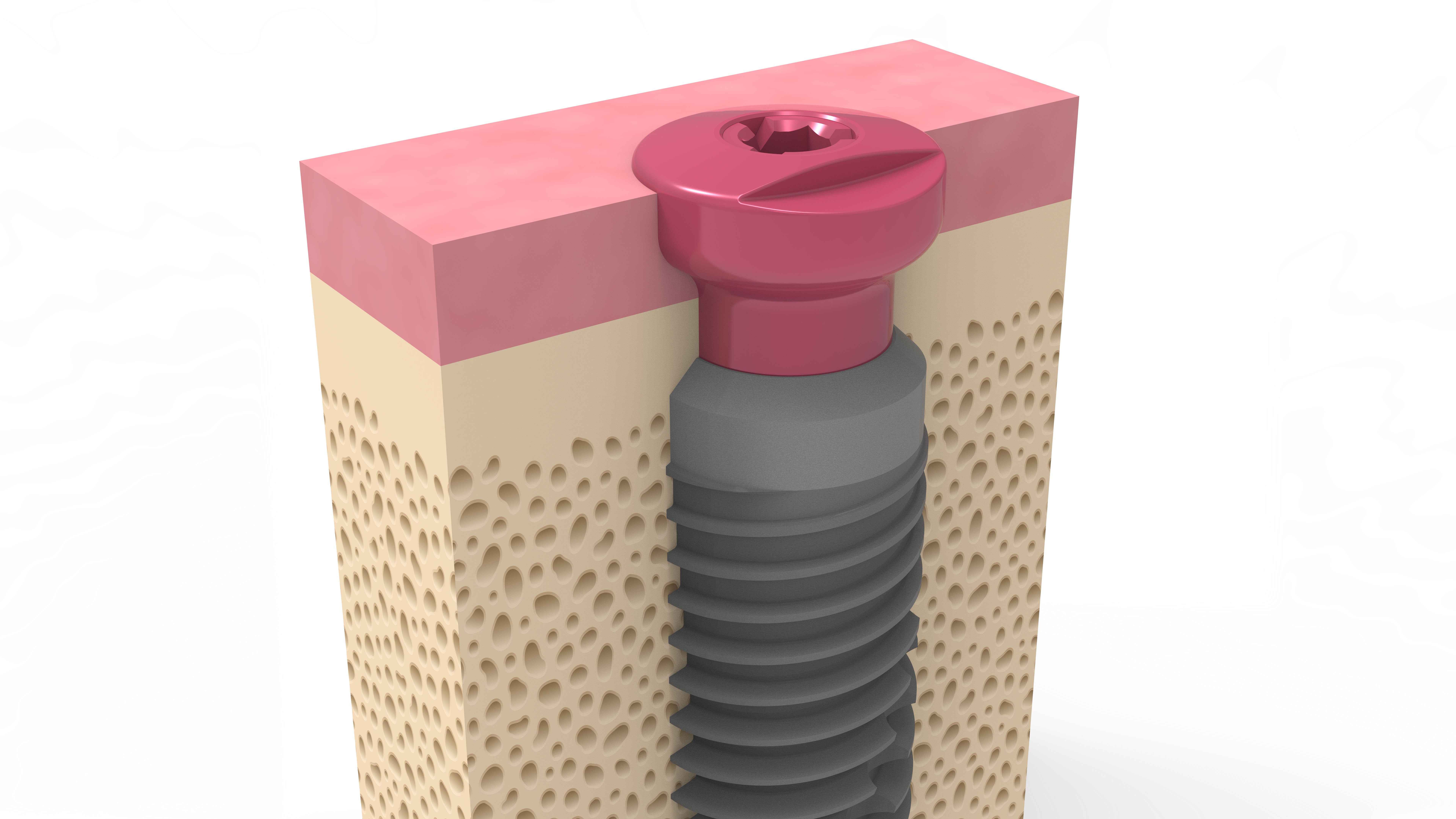 Encode® Emergence Healing & Impression System - Implacom BV